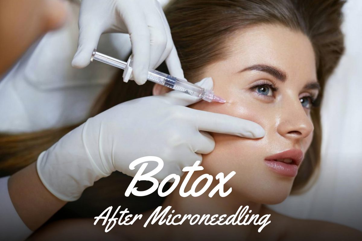 Can I Get Botox After Microneedling - Fitness Beauty Art
