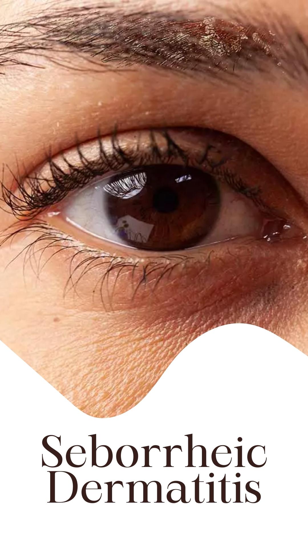 Seborrheic Dermatitis In Eyebrows - Fitness Beauty Art