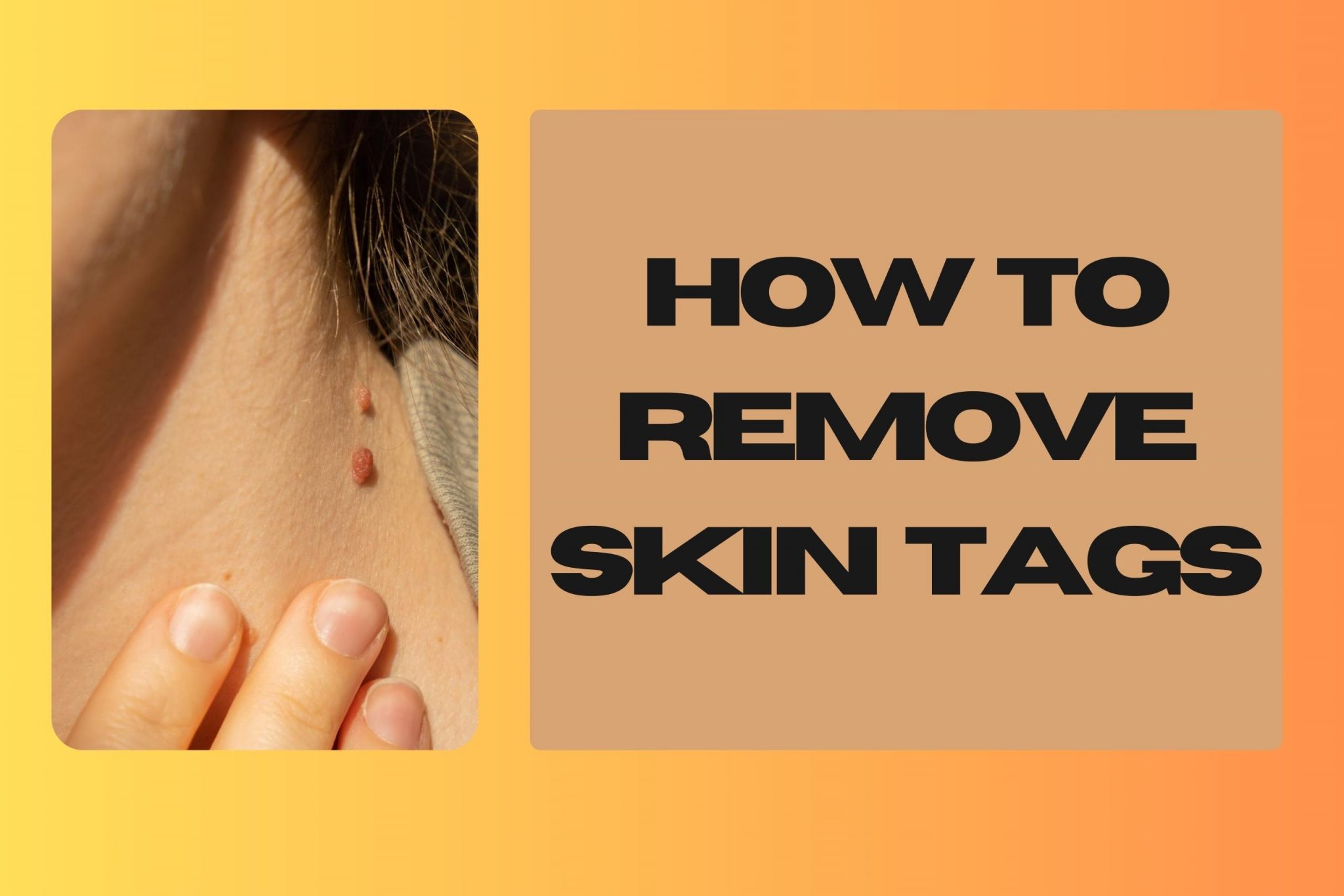 How To Remove Skin Tags - Fitness Beauty Art